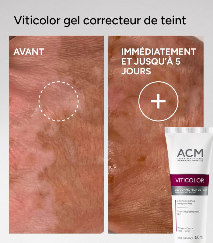 VITICOLOR | Gel Correcteur de Teint pour Vitiligo